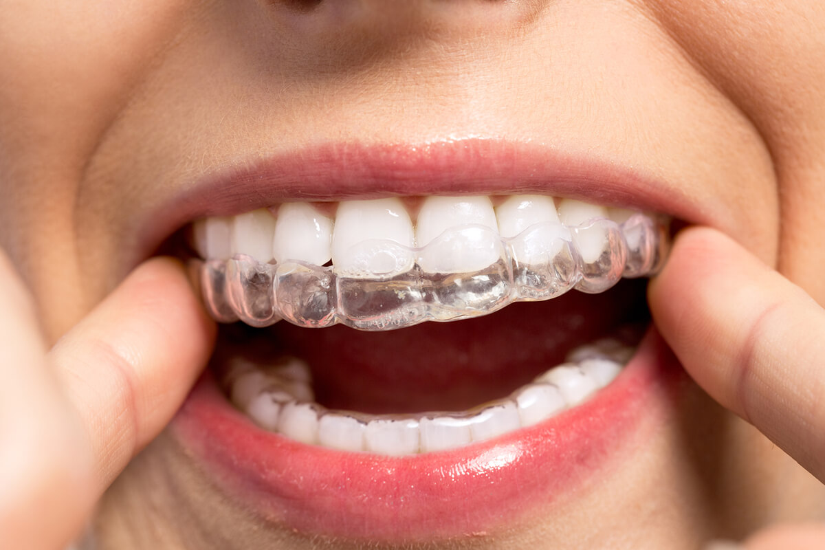 Exclusive Invisalign Day Savings | Kensington Natural Smiles